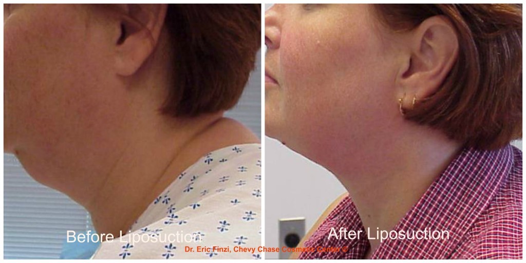 How To Eliminate Neck Fat Known As Turkey Neck and Double Chin