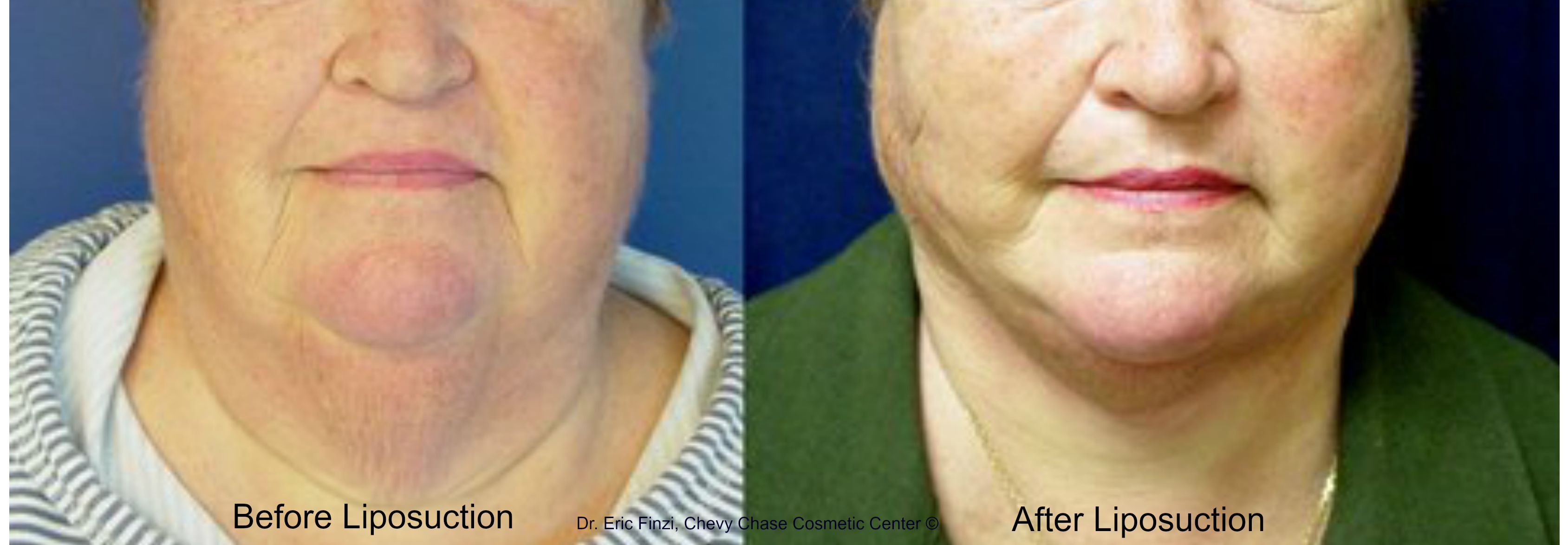 How To Eliminate Neck Fat Known As Turkey Neck and Double Chin