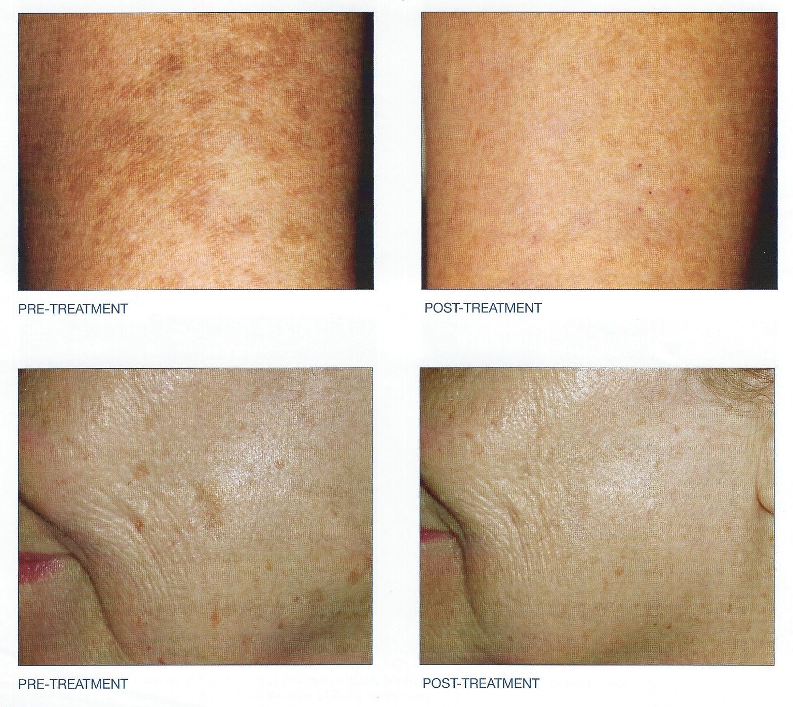 How to Treat Melasma, Brown Age Spots and Other Pigmented Skin Issues