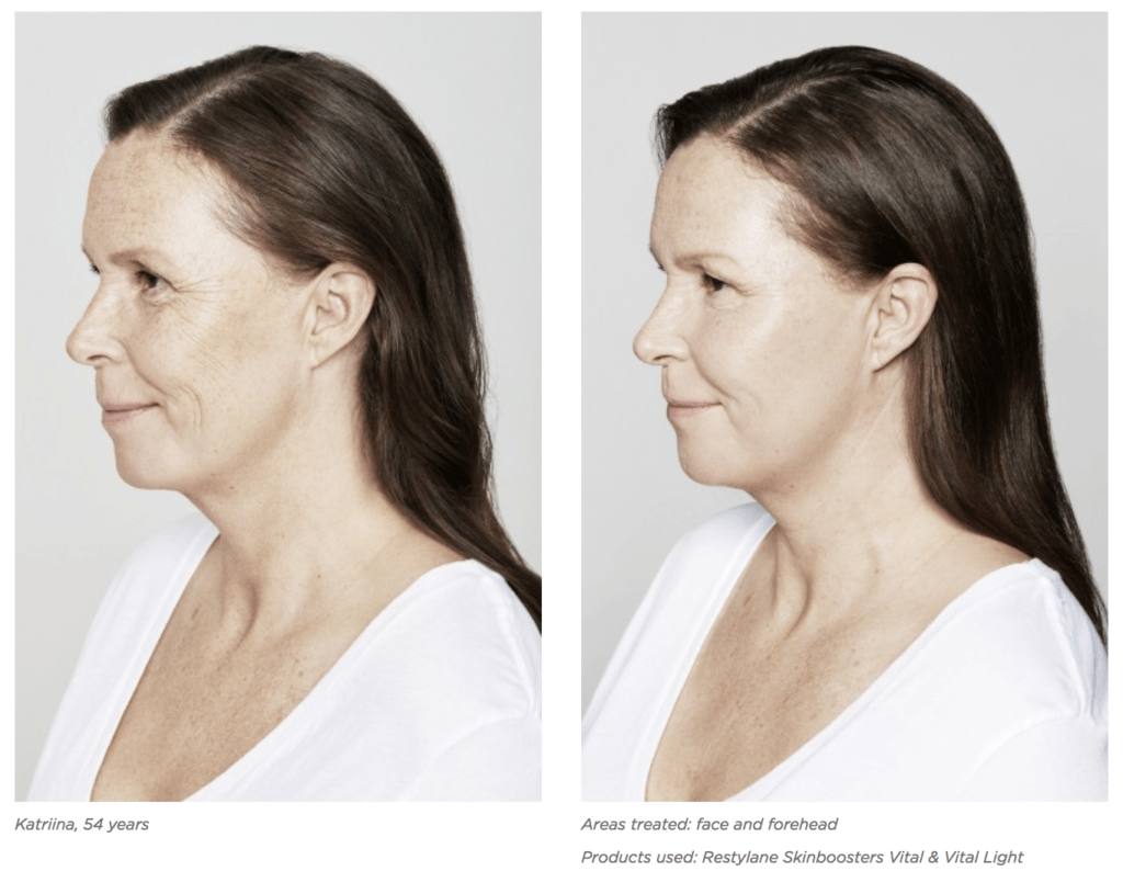 Fat Transfer vs. Dermal Fillers to Look Years Younger
