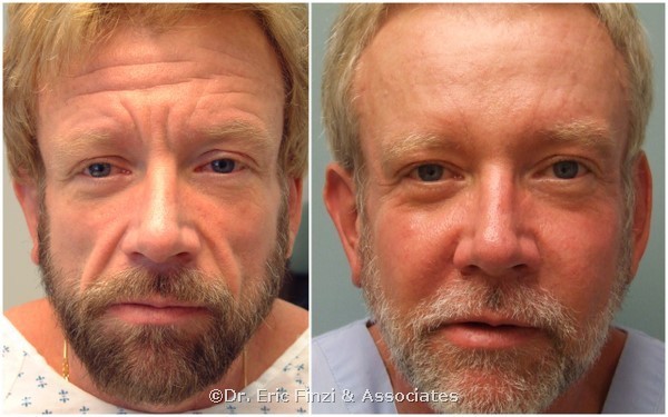 Fat Transfer vs. Dermal Fillers to Look Years Younger