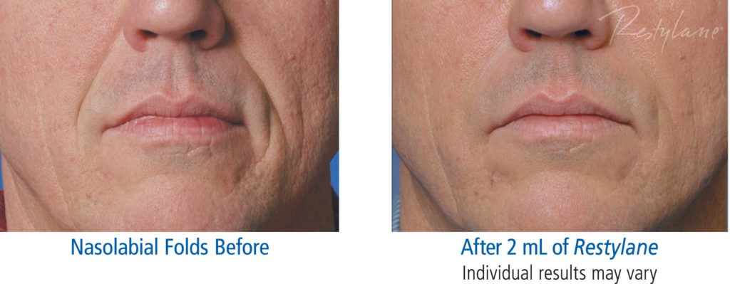 Fat Transfer vs. Dermal Fillers to Look Years Younger