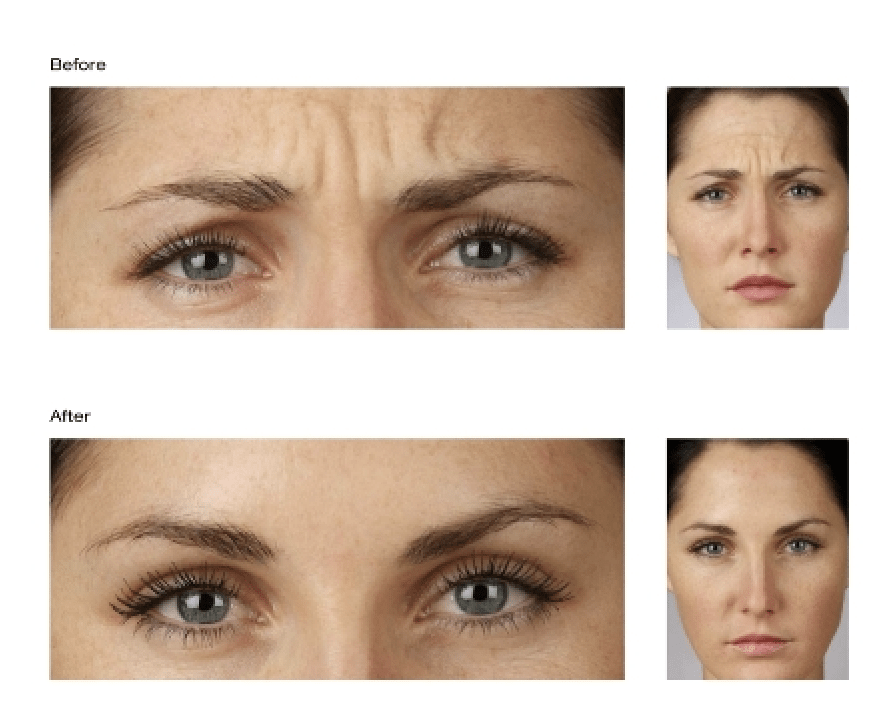 Botox Sprinkles and Baby Botox for Different Stages in Life